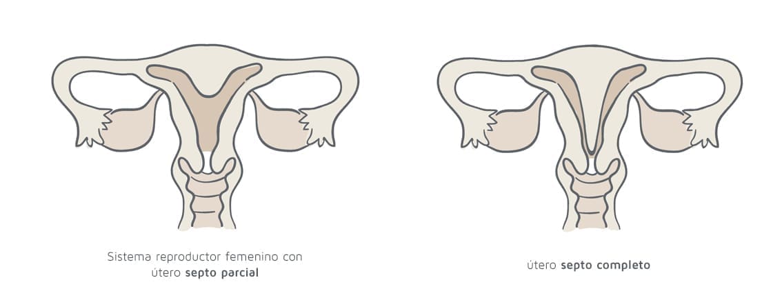 Tipos de malformaciones uterinas: clasificación y características